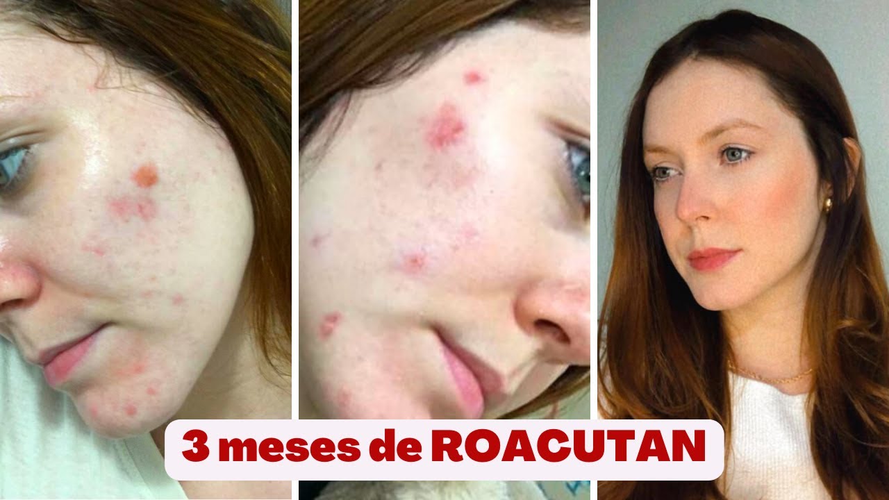 3 meses de ROACUTAN - Minha experiência até aqui