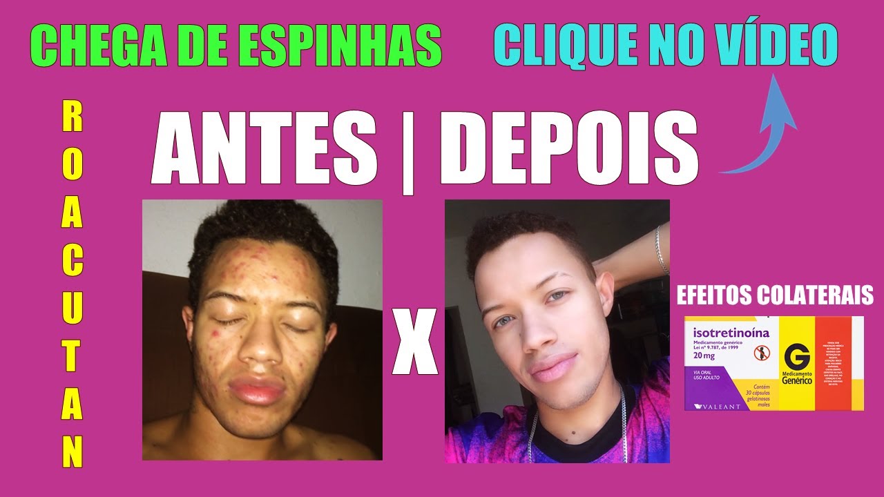 Roacutan 8º Mês de Tratamento e Produtos que estou utilizando