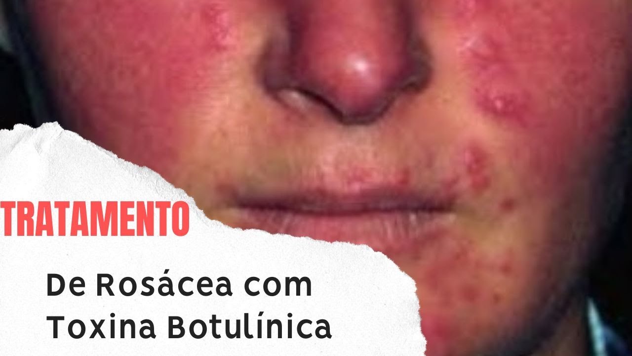 Tratamento de ROSÁCEA com TOXINA BOTULÍNICA