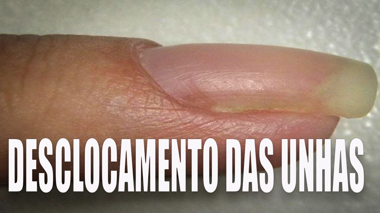 DESLOCAMENTO DAS UNHAS - Como evitar e como tratar