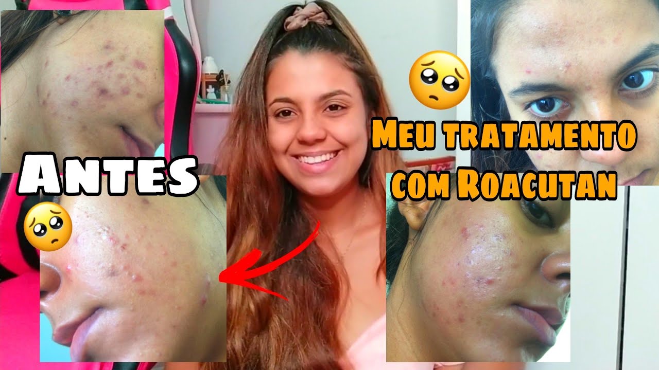 como foi meu tratamento com o Roacutan? contei toda a minha história ...