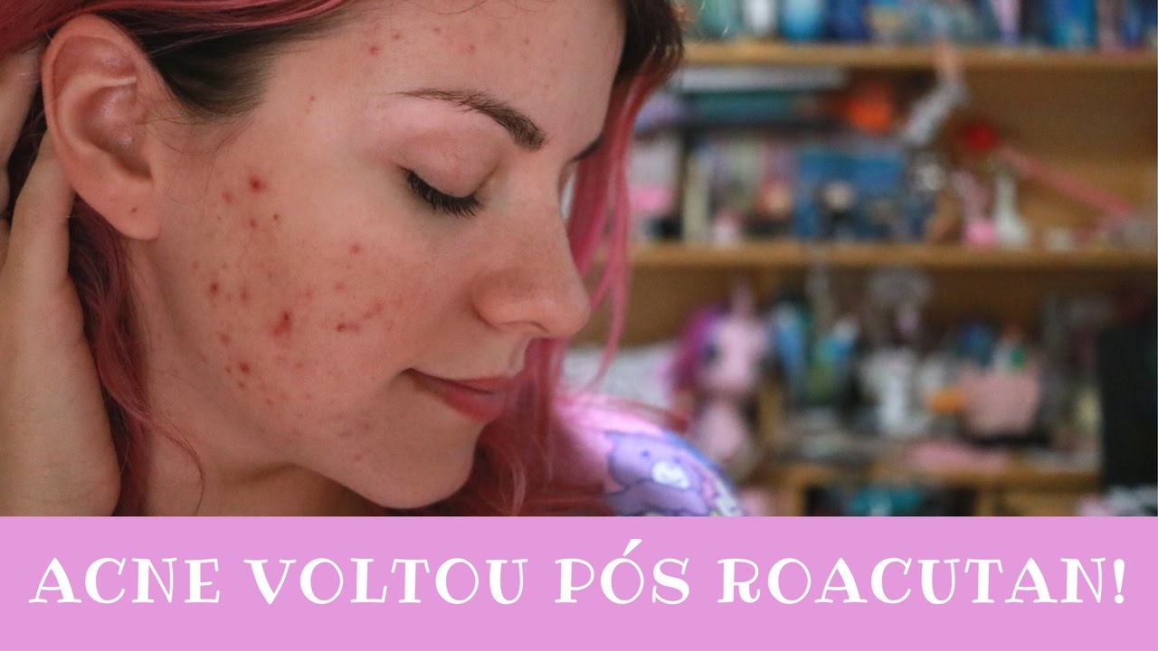 Após Roacutan, Acne Voltou! Falando Sobre Relapso 5 Anos Após ...