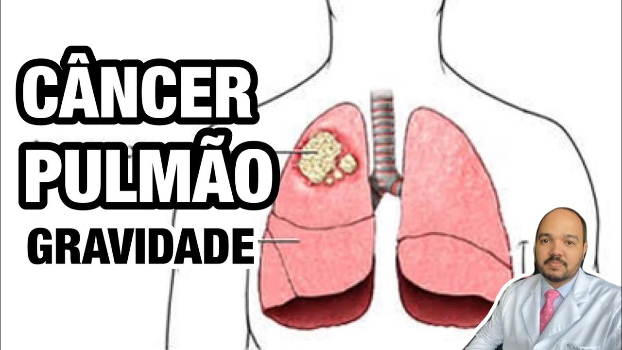 Câncer de pulmão: fases e sintomas iniciais