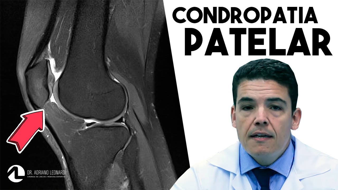 Condropatia Patelar: Sintomas e Tratamento.