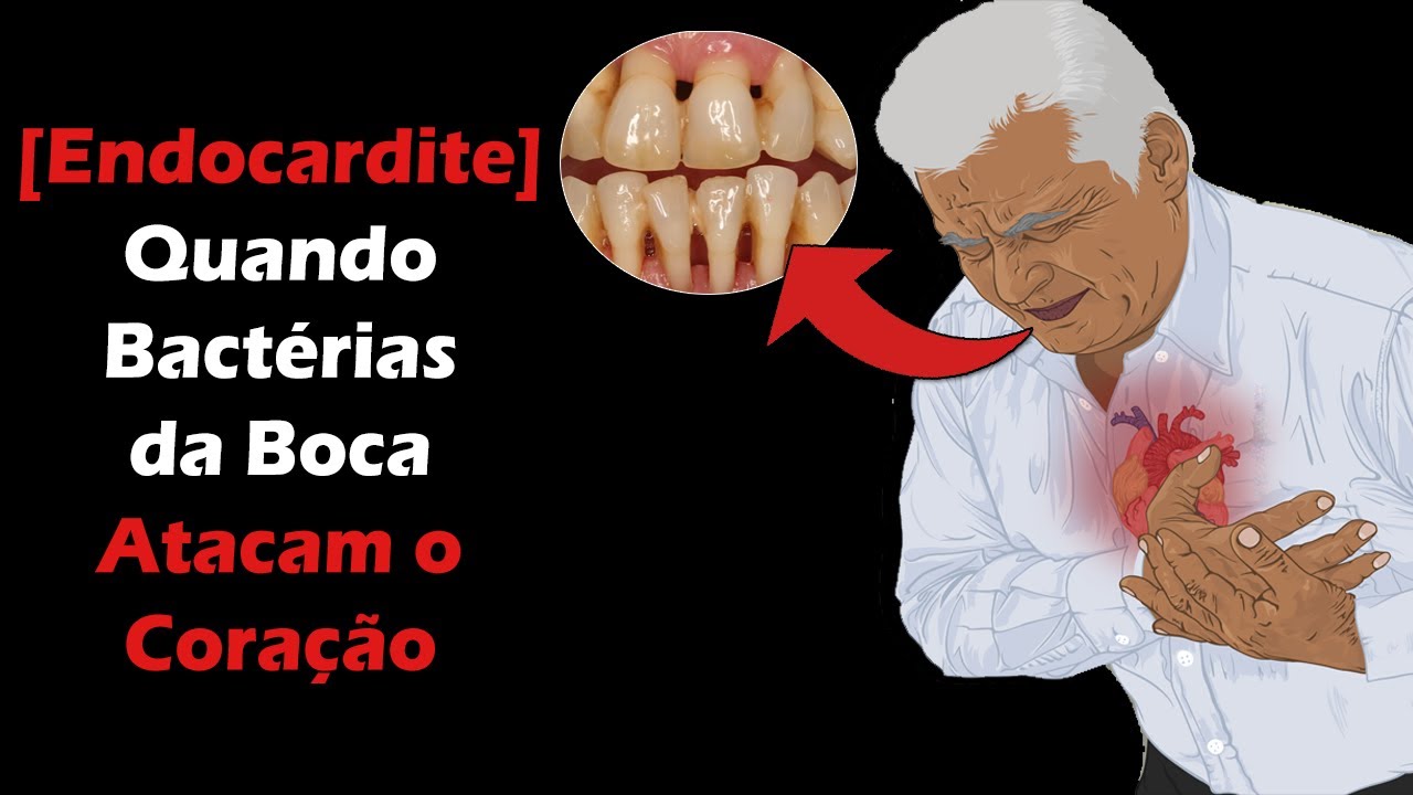 Endocardite Bacteriana: Causas e Sintomas da Infecção Cardíaca por ...
