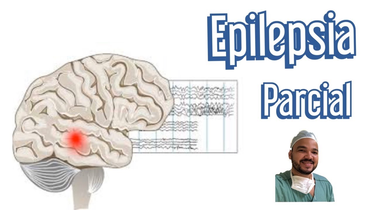 Entenda a Crise Focal na Epilepsia: Causas, Sintomas e Tratamentos