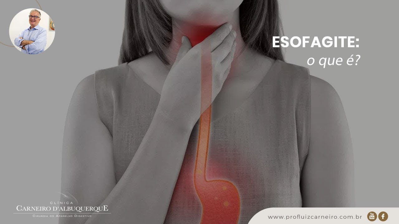 Esofagite: causas, sintomas e tratamento eficaz