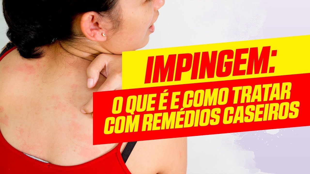 Impingem: causas, sintomas e tratamento com remédios caseiros.