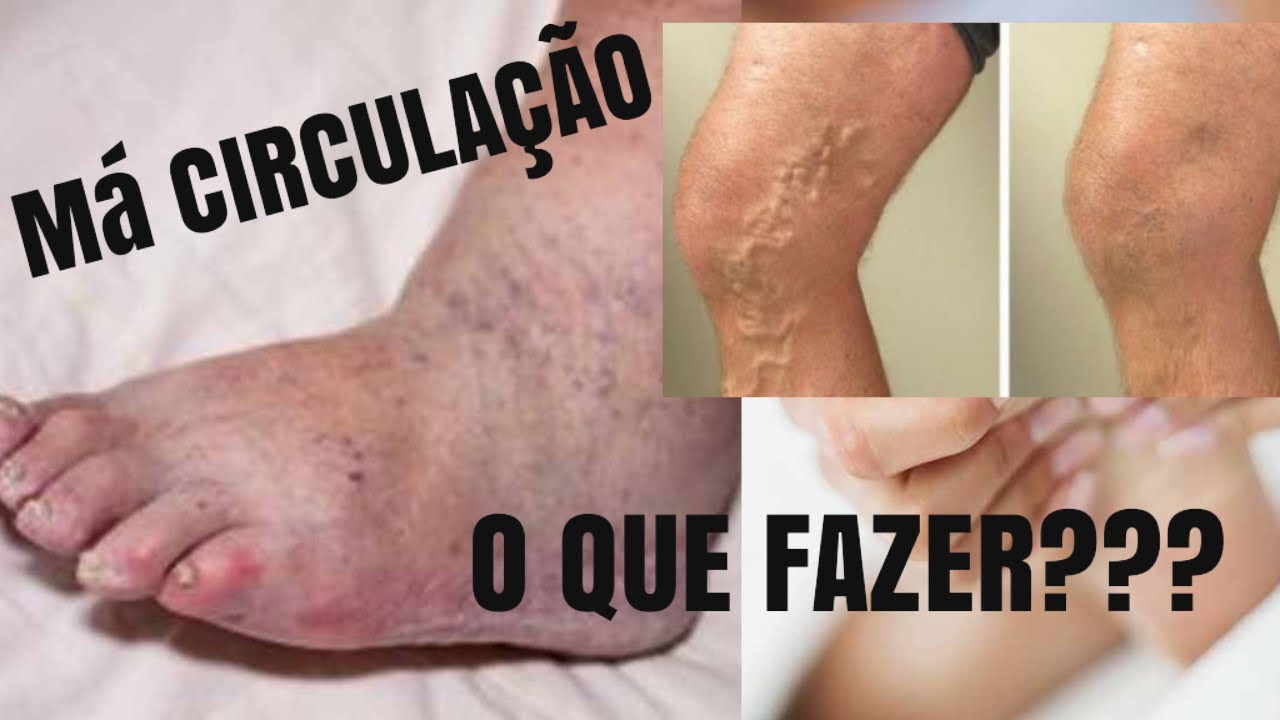 Melhore a circulação com remédio caseiro fácil