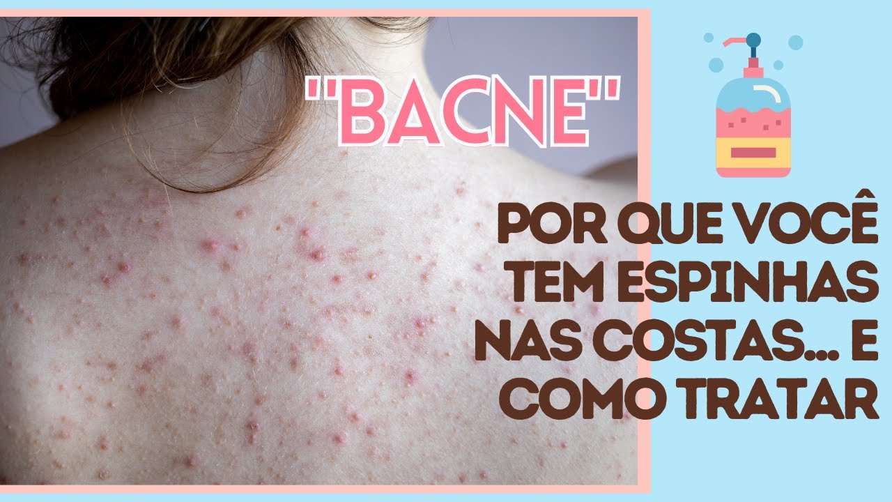 Tratamento de acne corporal: como cuidar de espinhas nas costas, colo ...