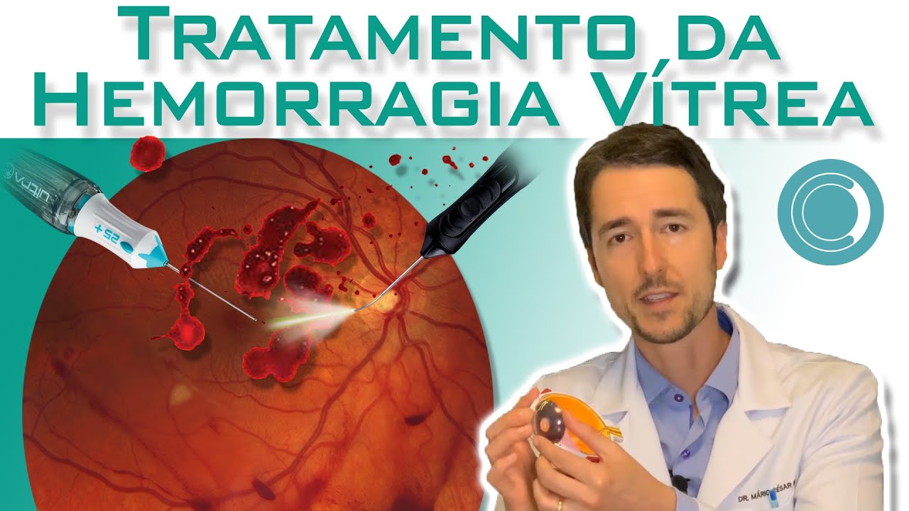 Tratamento de Hemorragia Vítrea: Cirurgia de Vitrectomia