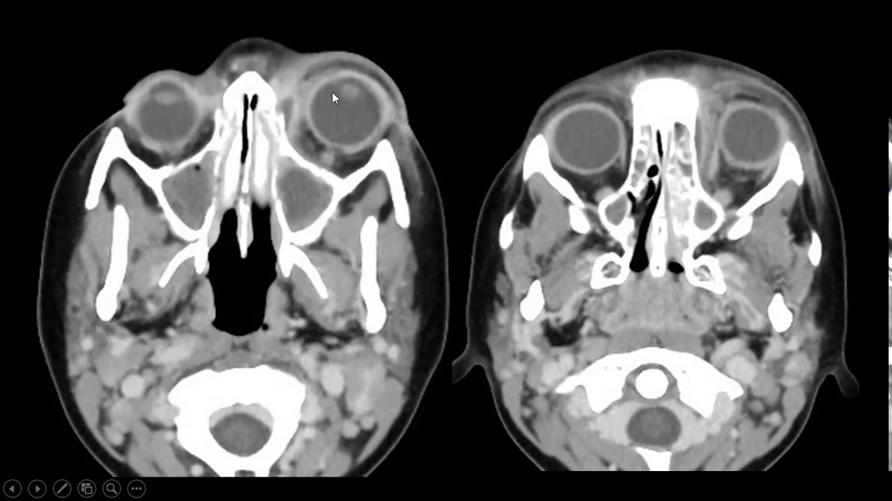 Tratamento e prevenção de sinusite e celulite orbitária.