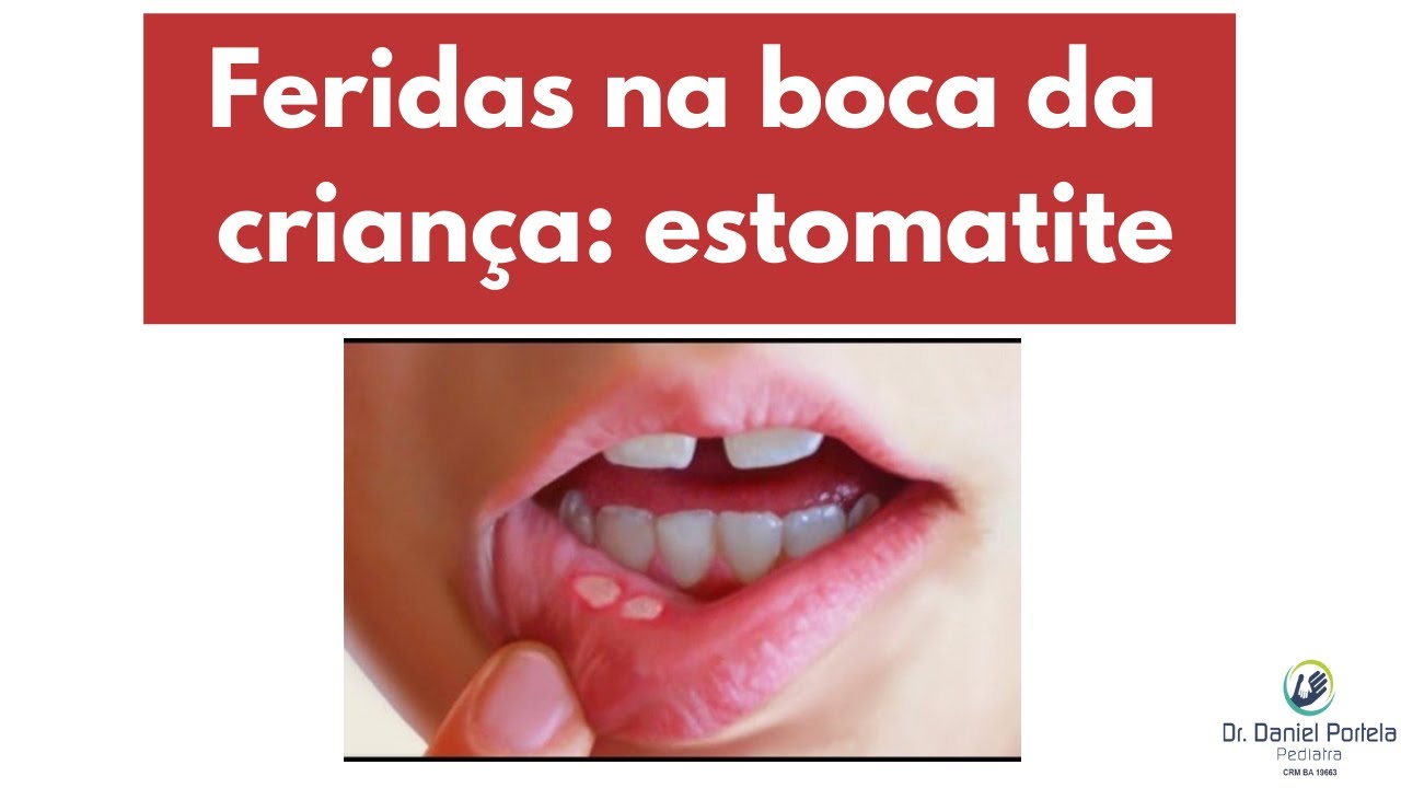 Tratando estomatite infantil: aftas e feridas na boca