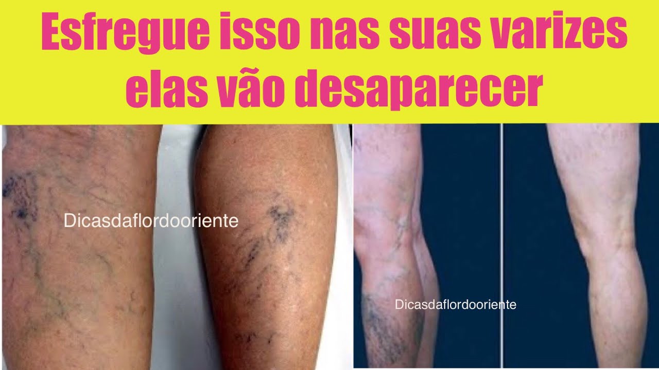 Como tratar varizes de forma natural e eficaz?