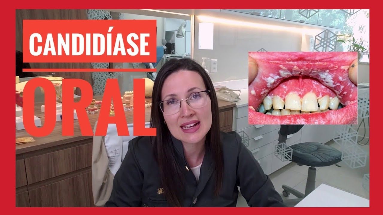 Candidíase oral: sintomas, causas e tratamento com a Dra. Danielle Sales