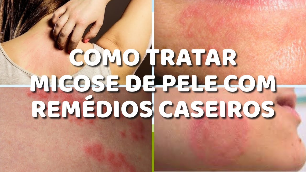 Como acabar com a micose de pele de forma rápida e eficaz