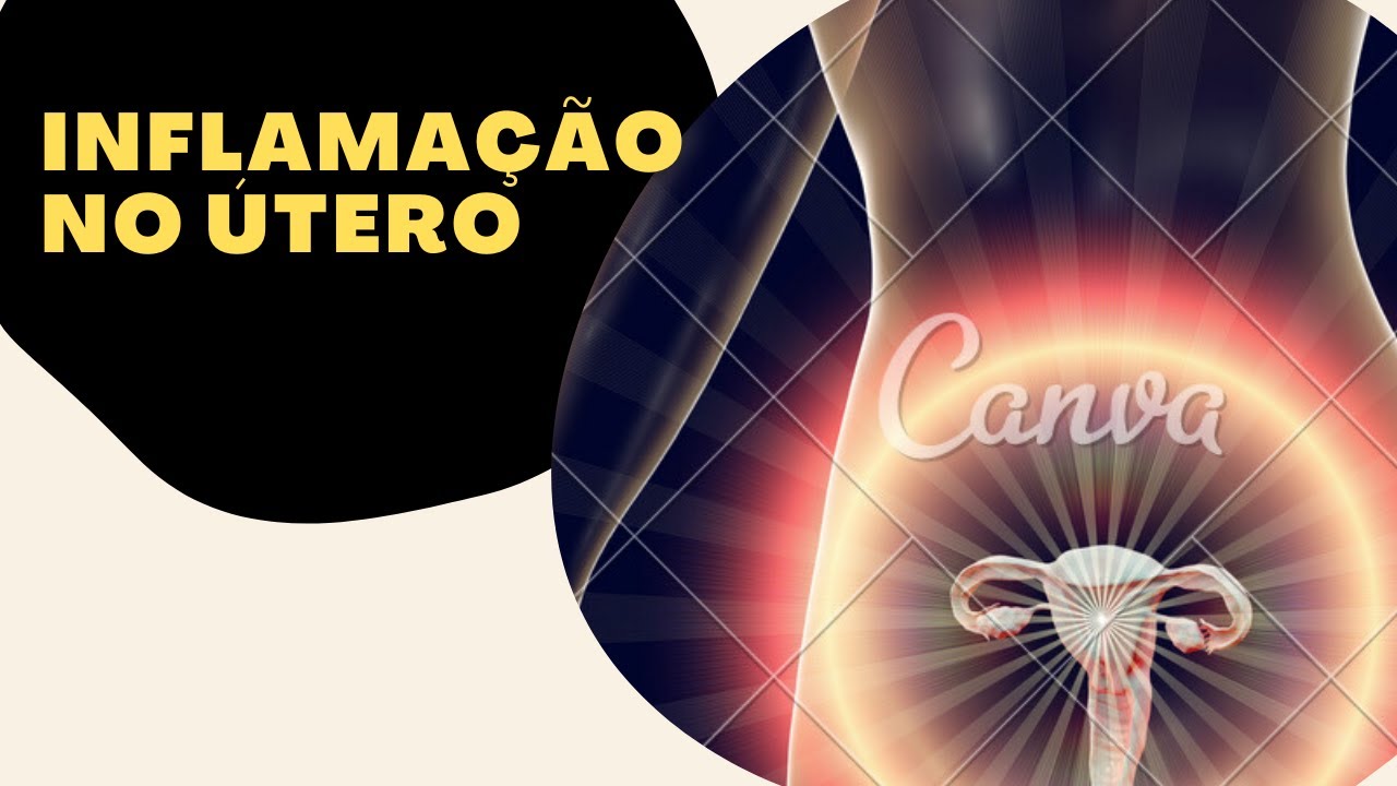 Entenda Mais Sobre Inflamação Uterina E Seus Sintomas