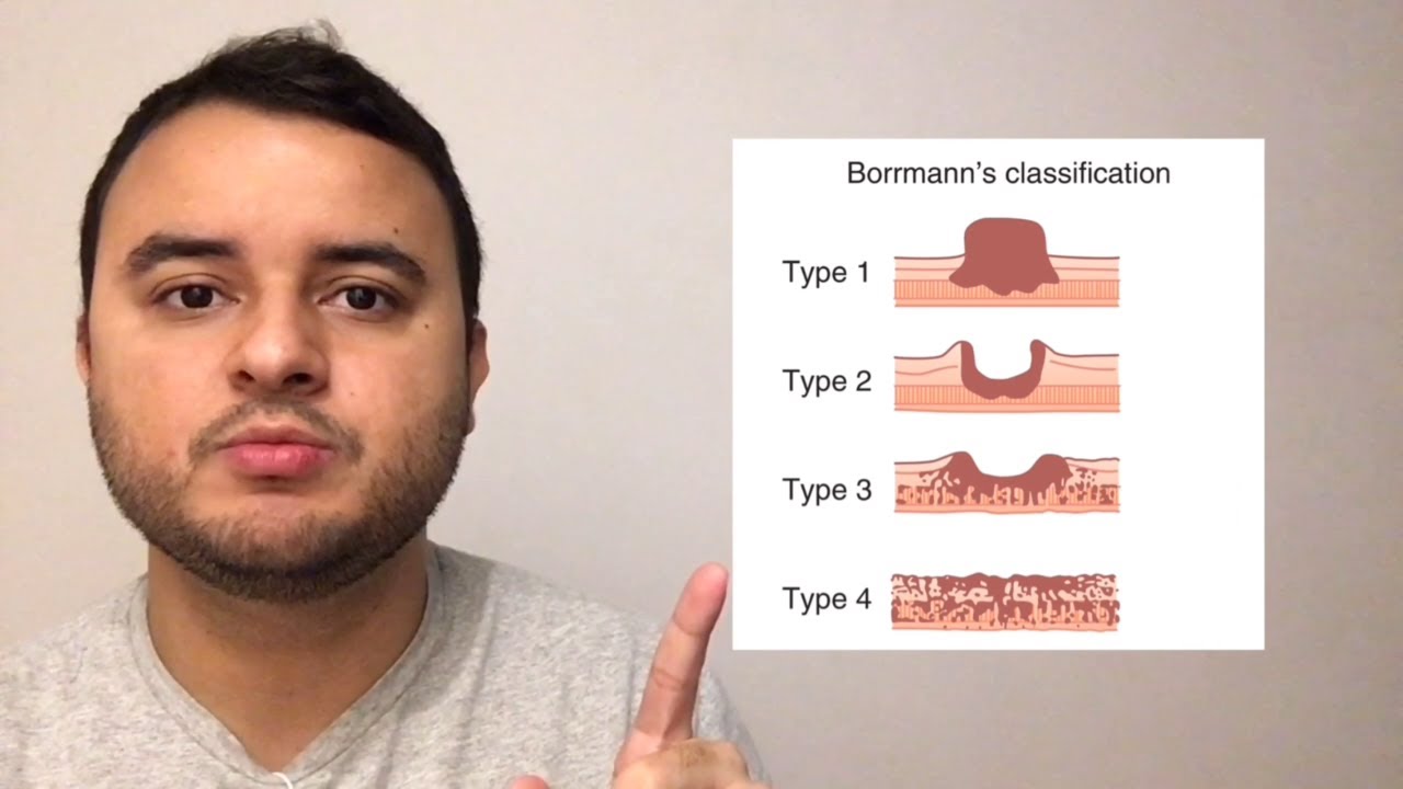 Saiba mais sobre a Classificação de Borrmann: tipos, características e ...