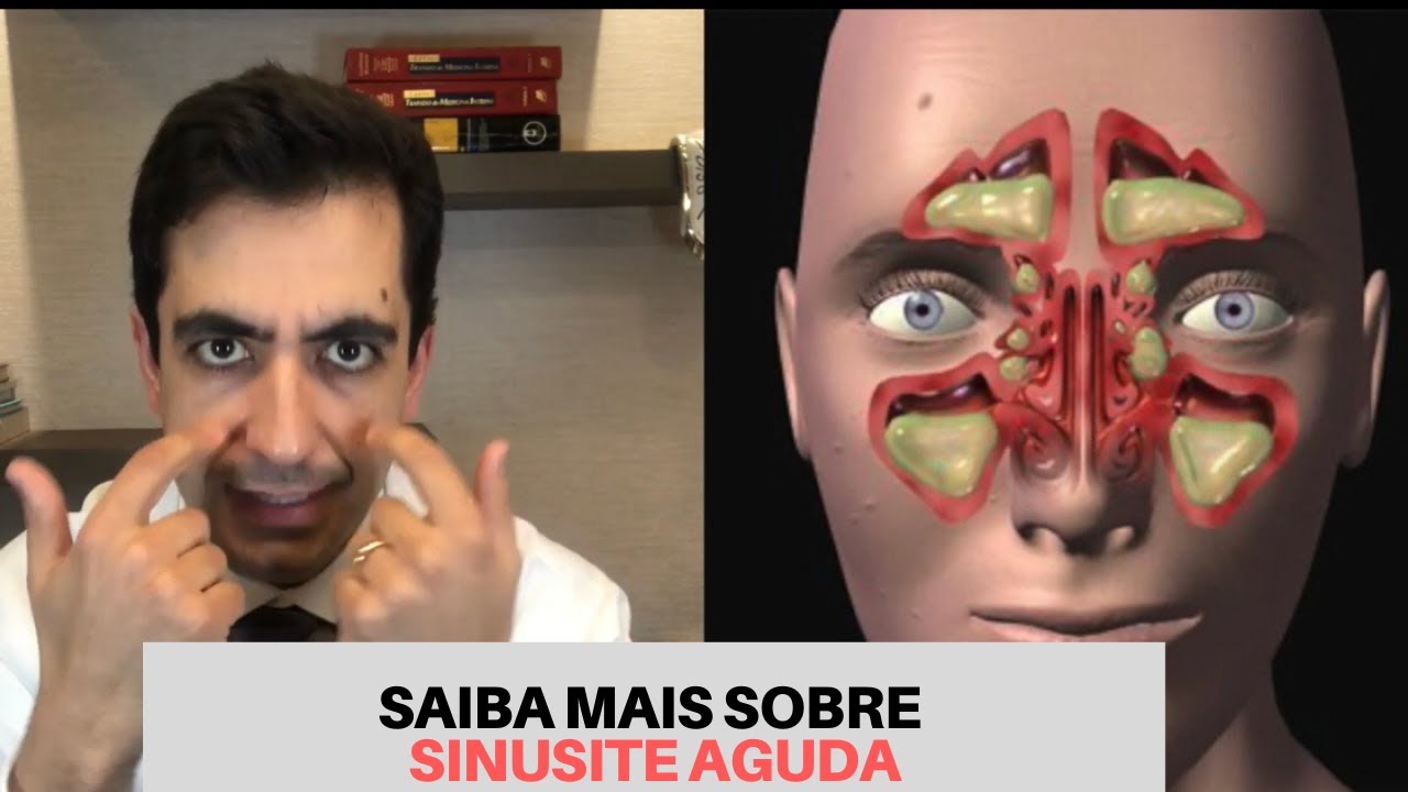 Sinusite Aguda: Tratamento com Antibiótico com Dr. Paulo Mendes Jr