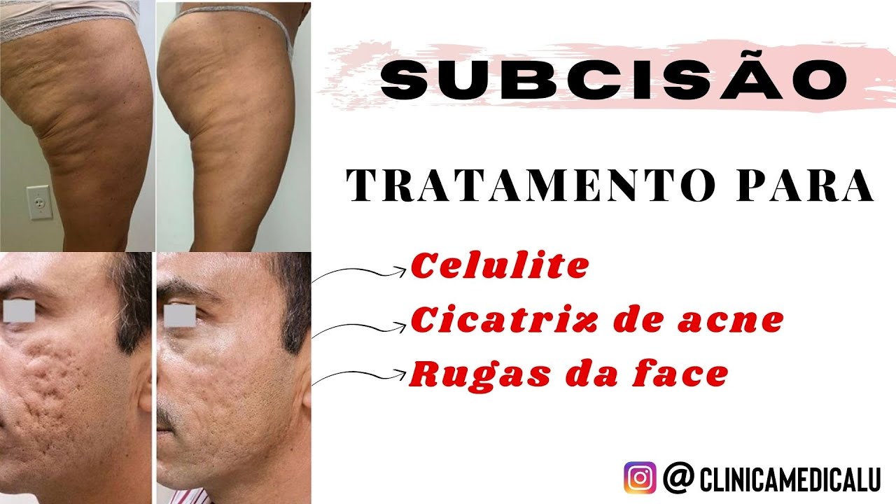Subcisão para Acne, Rugas e Celulite: A Solução para uma Pele Lisa # ...