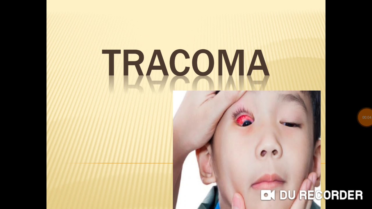 Tracoma: características, sintomas, transmissão e mais informações