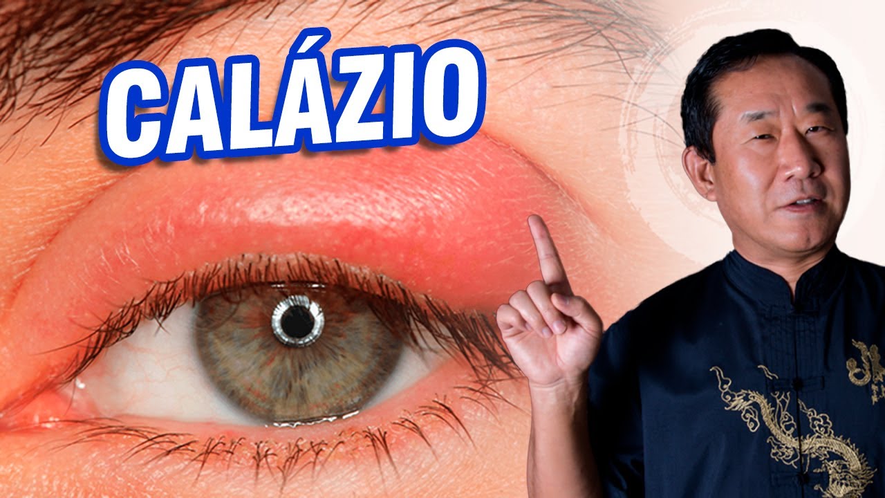Tratamento e causas do calázio ocular com Peter Liu