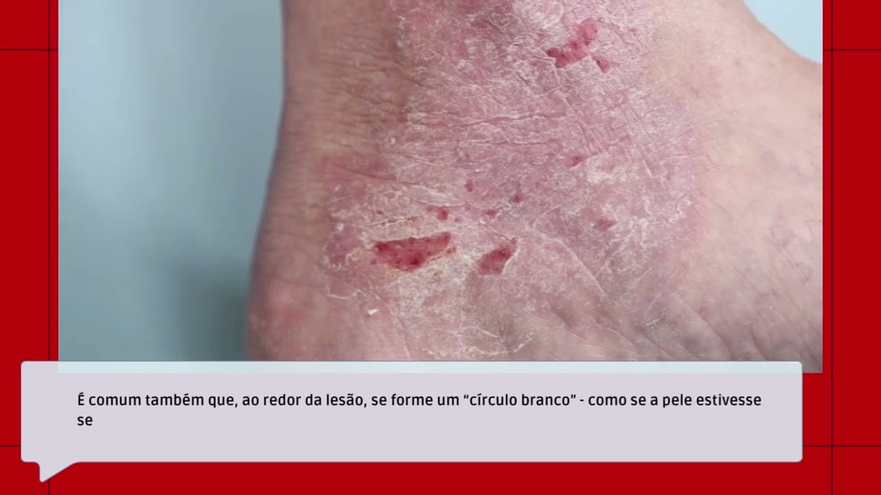 Tratamento para Psoríase: Causas, Sintomas e Prevenção.