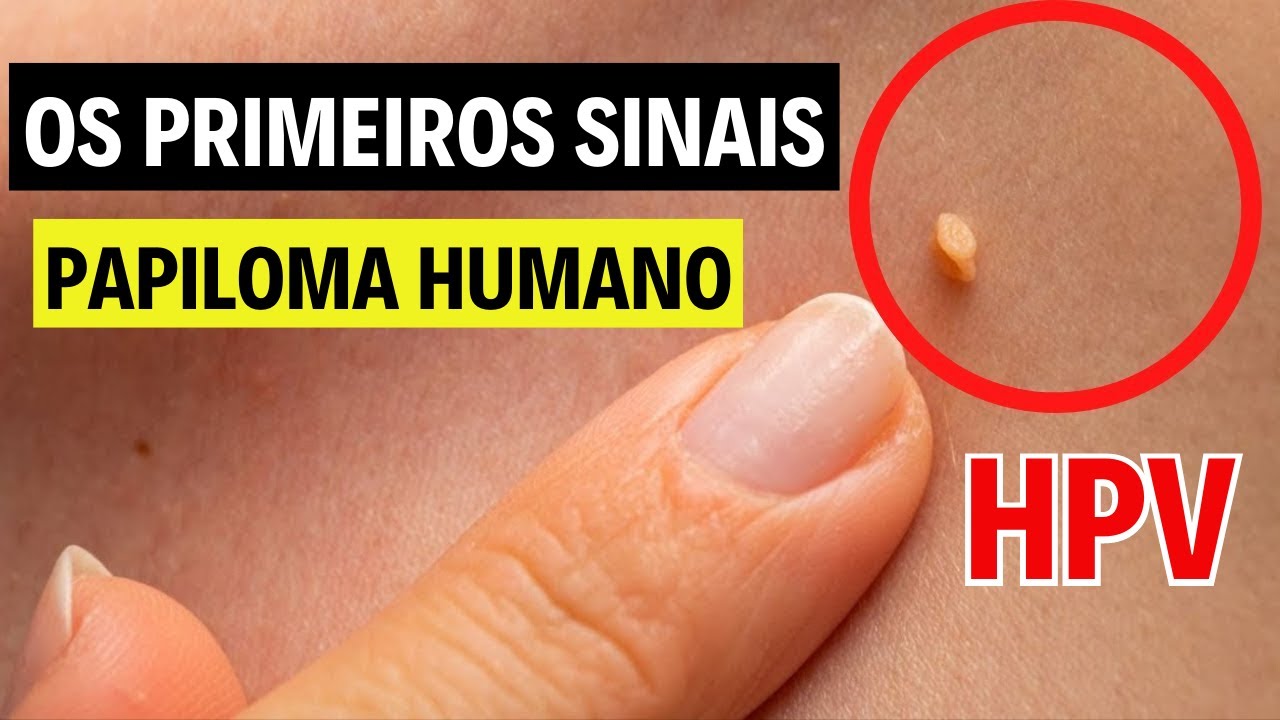 Sintomas de HPV: Conheça os sinais do Papiloma Vírus Humano.