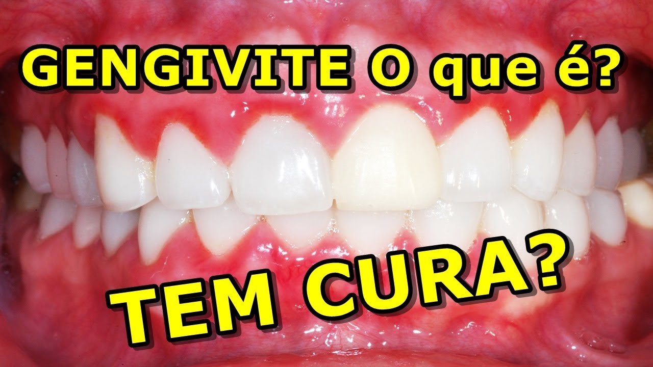 Tudo sobre gengivite: sintomas, tratamento e prevenção.