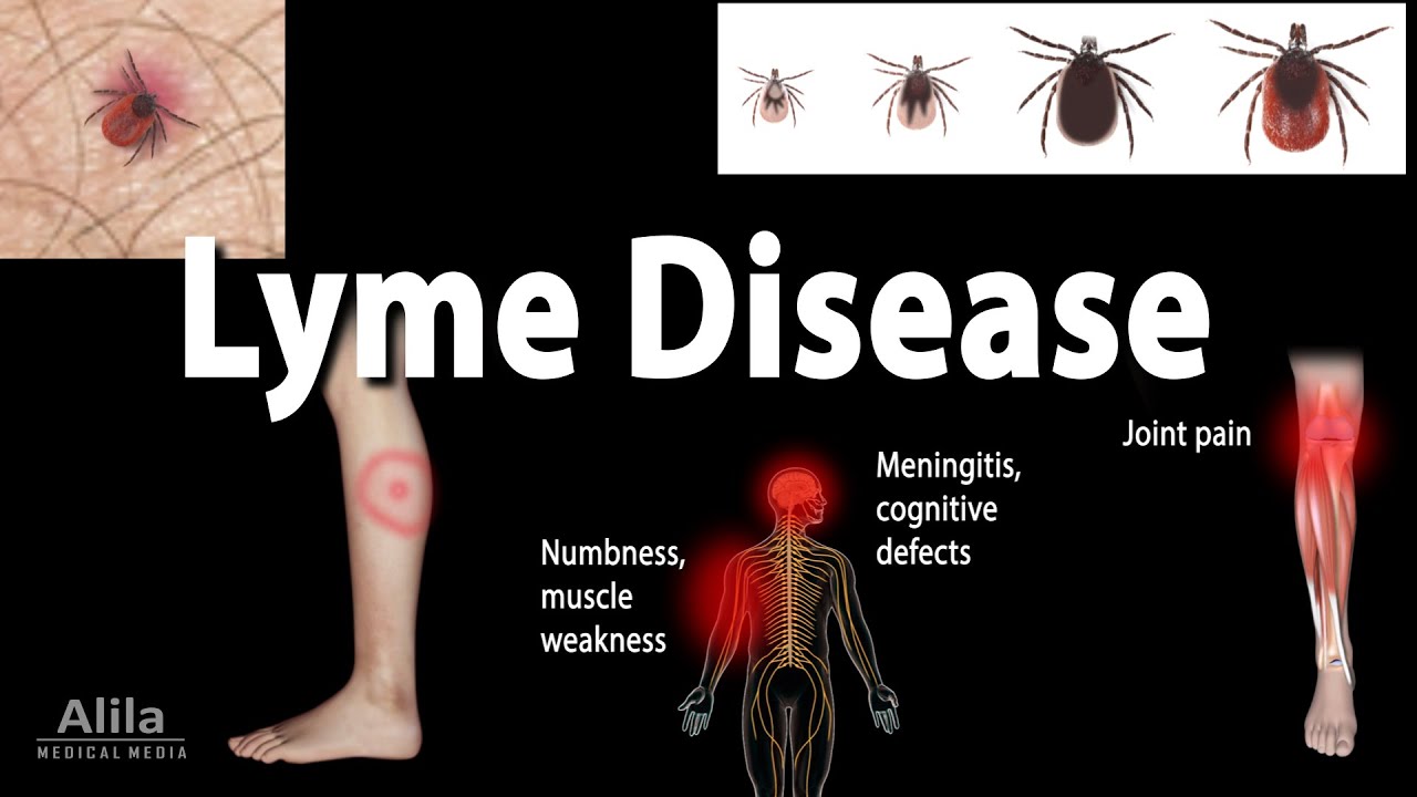 An Animated Guide to Lyme Disease - Symptoms, Treatment and Prevention