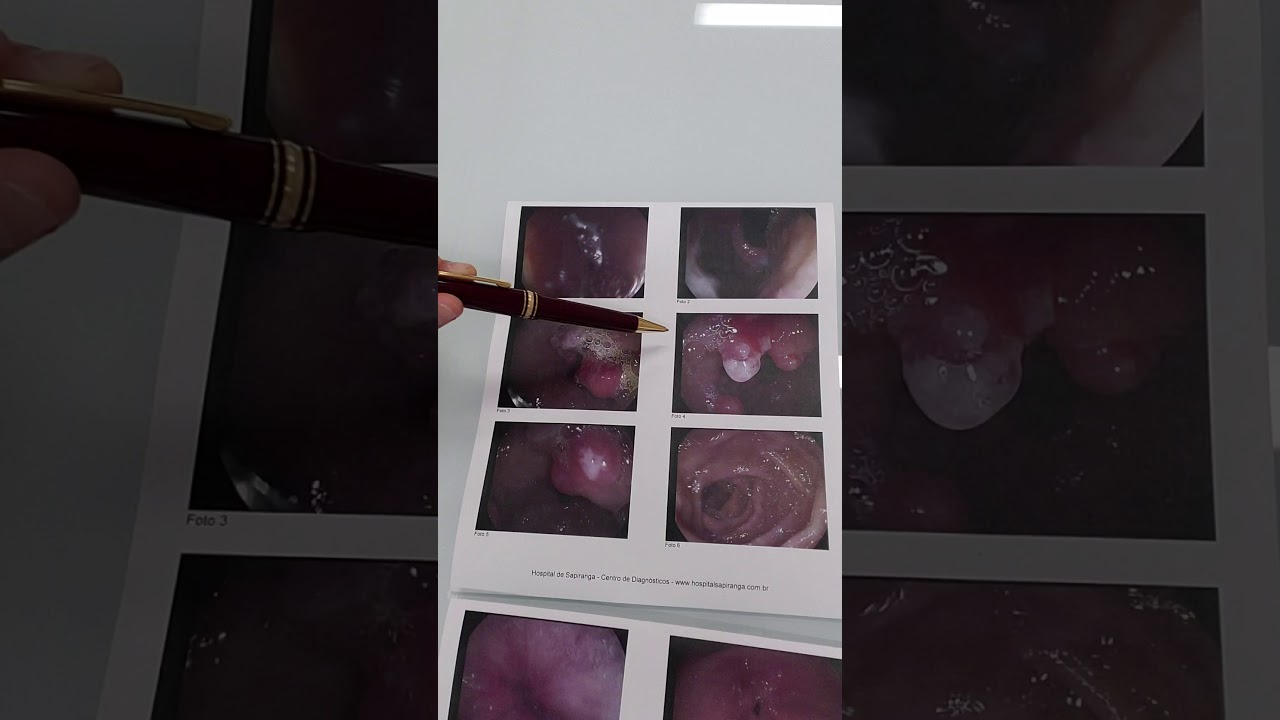 Diferença entre exame de endoscopia normal e com alterações: o que um ...