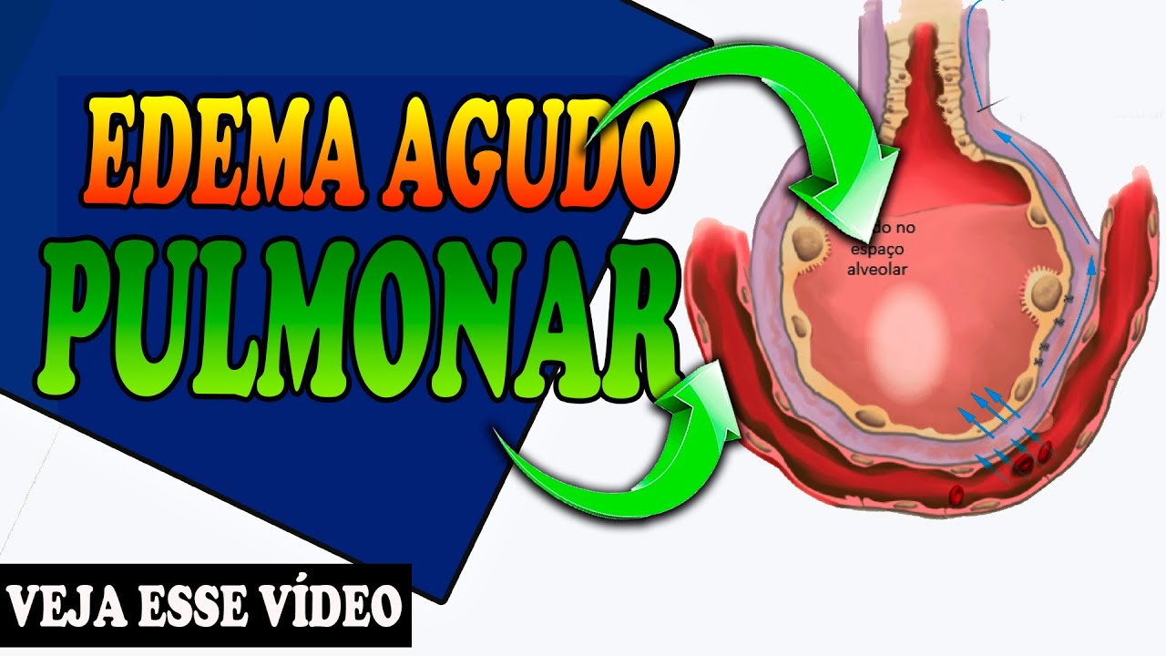 Edema Agudo de Pulmão: Sintomas e Fisiopatologia - Guia completo de ...