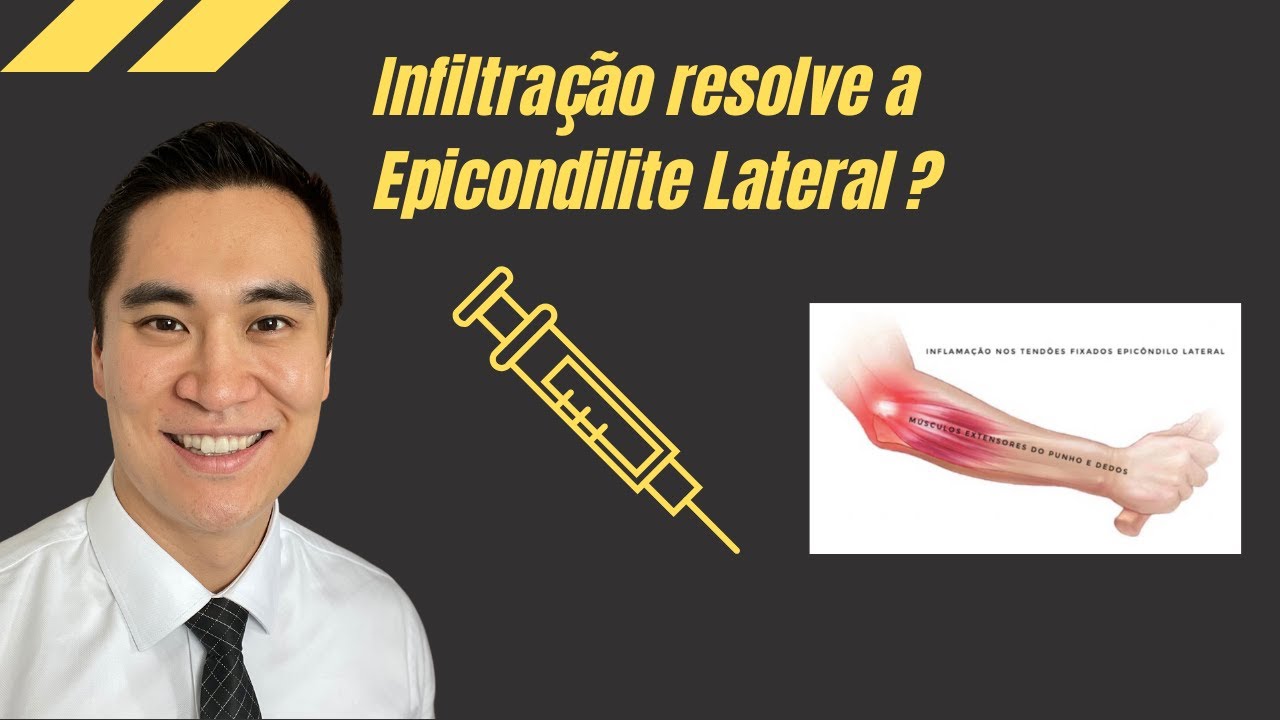 Epicondilite Lateral: O Tratamento com Infiltração.