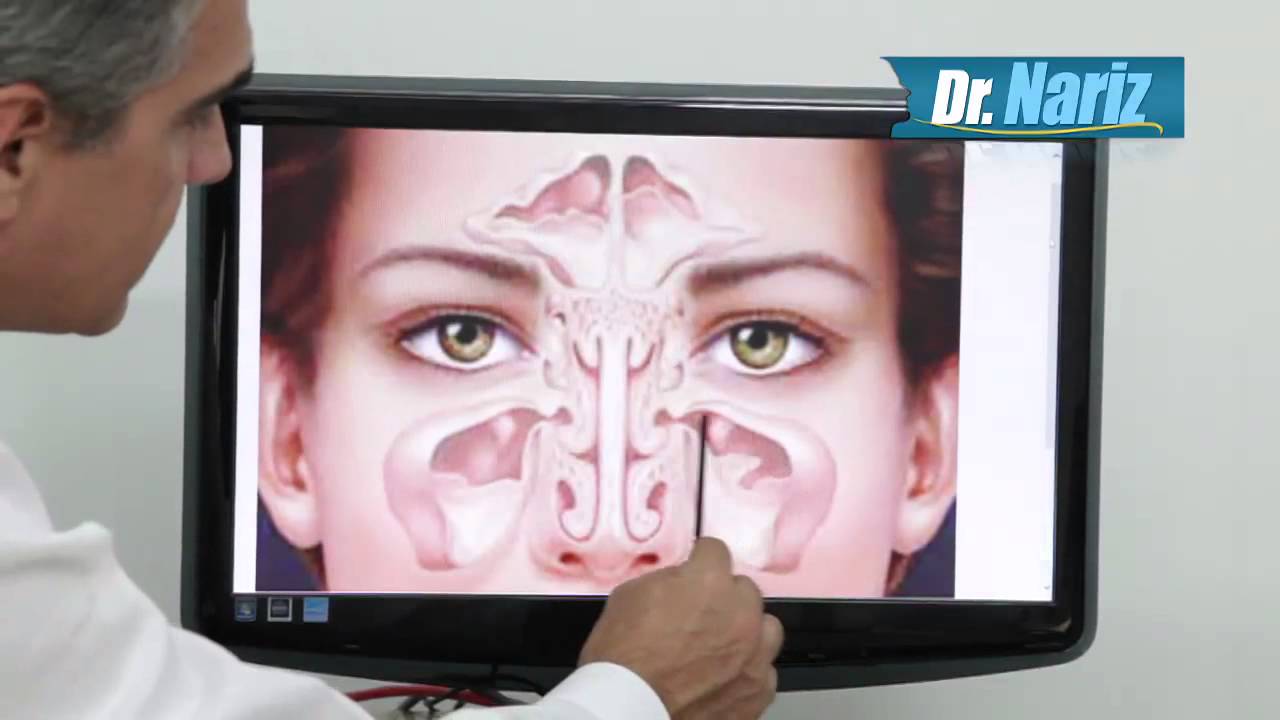 Rinite e Sinusite: Conheça as Diferenças e Sintomas.