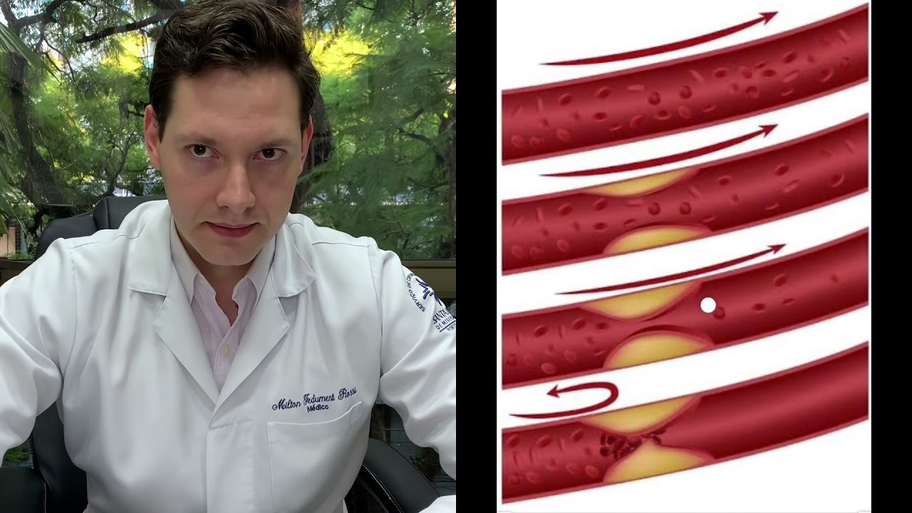 Ateroma de aorta: o que é e qual o risco?