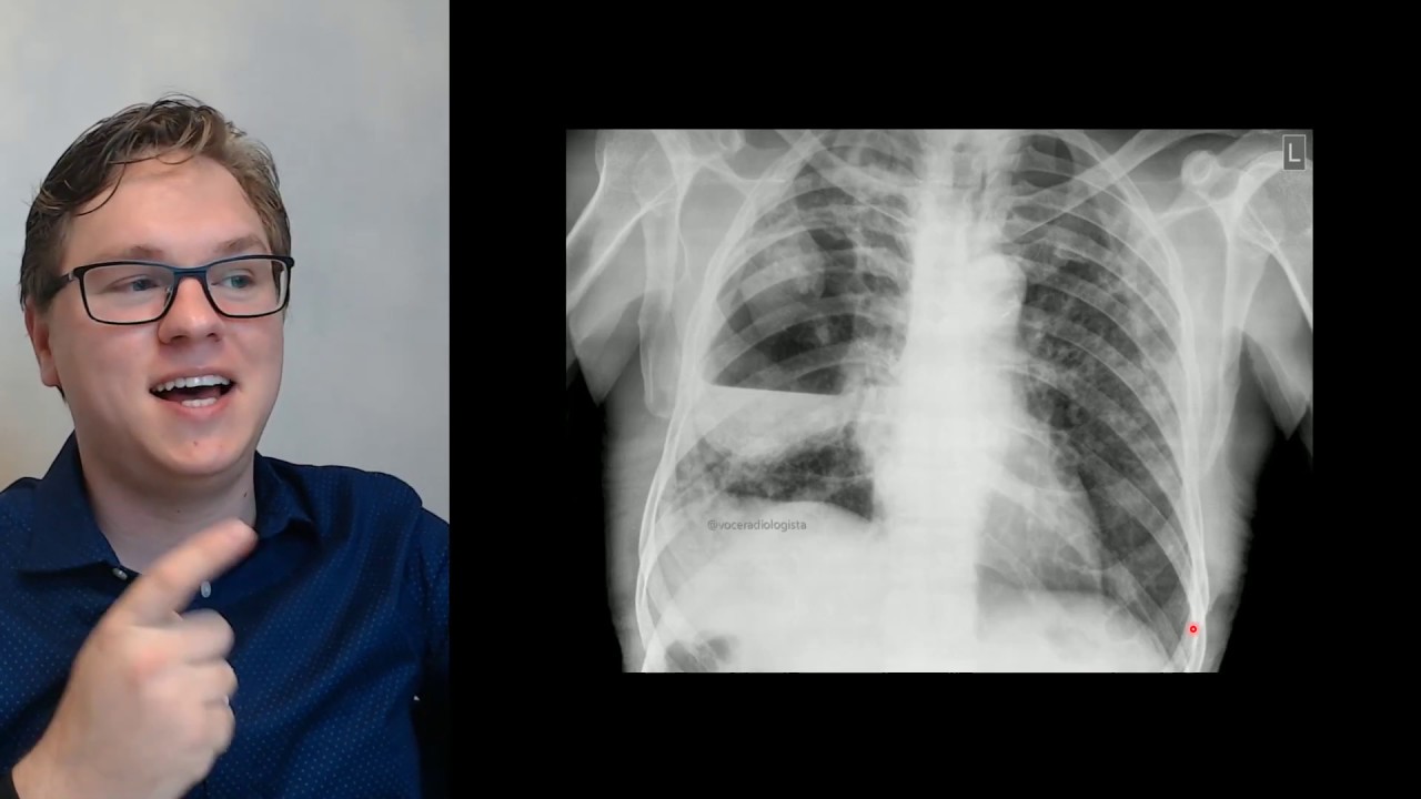 Abcesso Pulmonar: Causas, Sintomas e Tratamento | Dica do Rádio