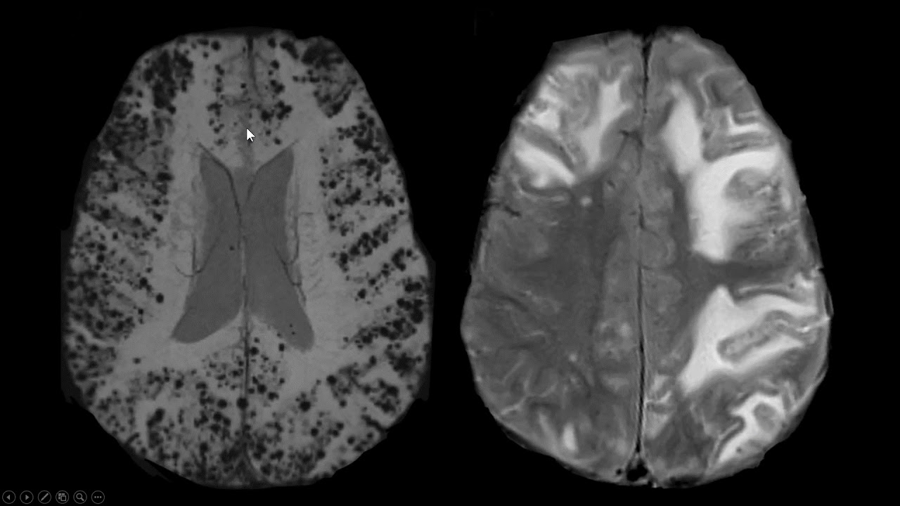 Angiopatia amilóide: causas, sintomas e tratamentos.