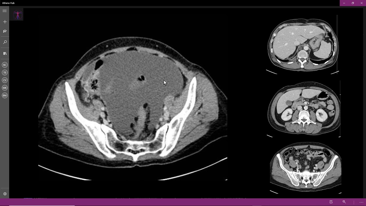 Ascite: Causas, sintomas, tratamentos e prevenção