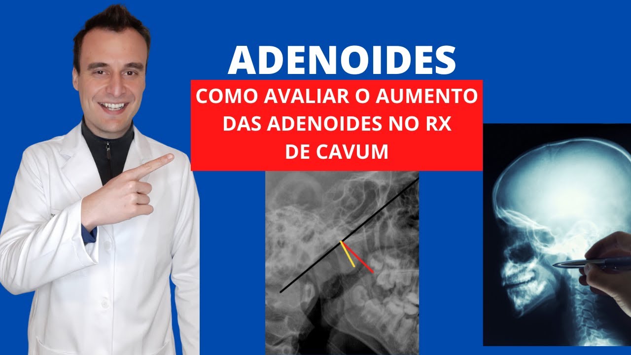 Aumento ou Hipertrofia de Adenoide: Avaliação e Localização - Entenda o ...