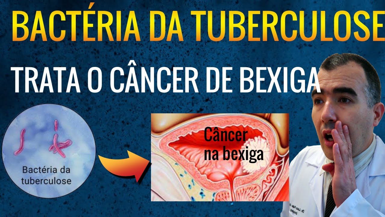 Bactéria da Tuberculose combate câncer na bexiga: descoberta surpreendente.