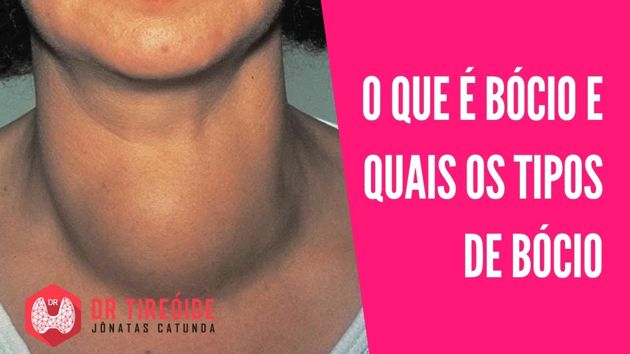 Bócio: O que é, tipos (multinodular, difuso) | Dr. Jônatas Catunda