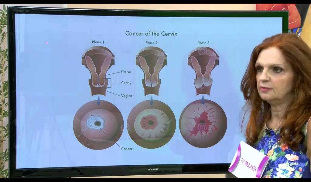 Câncer de colo de útero: sintomas, tratamentos e prevenção.