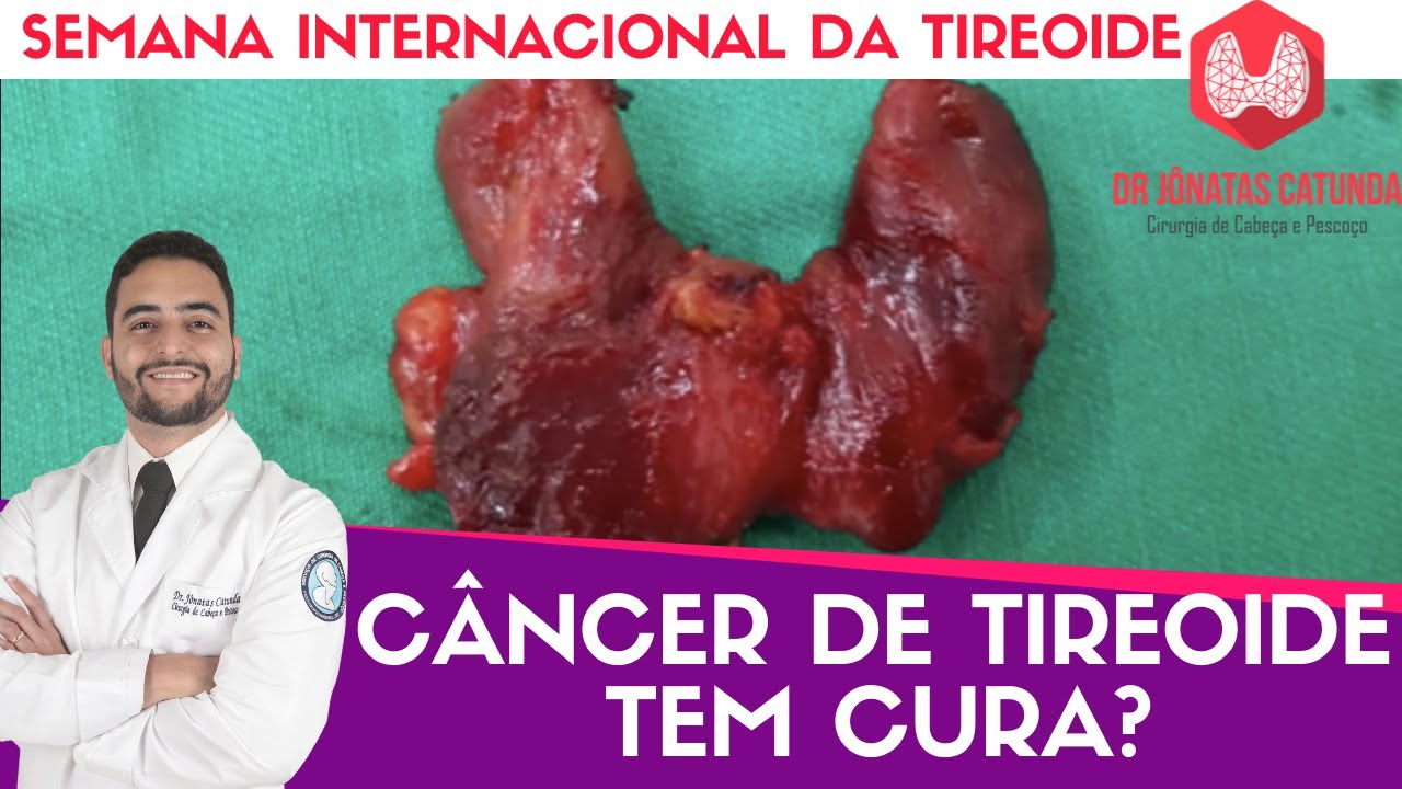 Câncer de tireoide: Saiba sobre tratamentos e cura - Semana ...