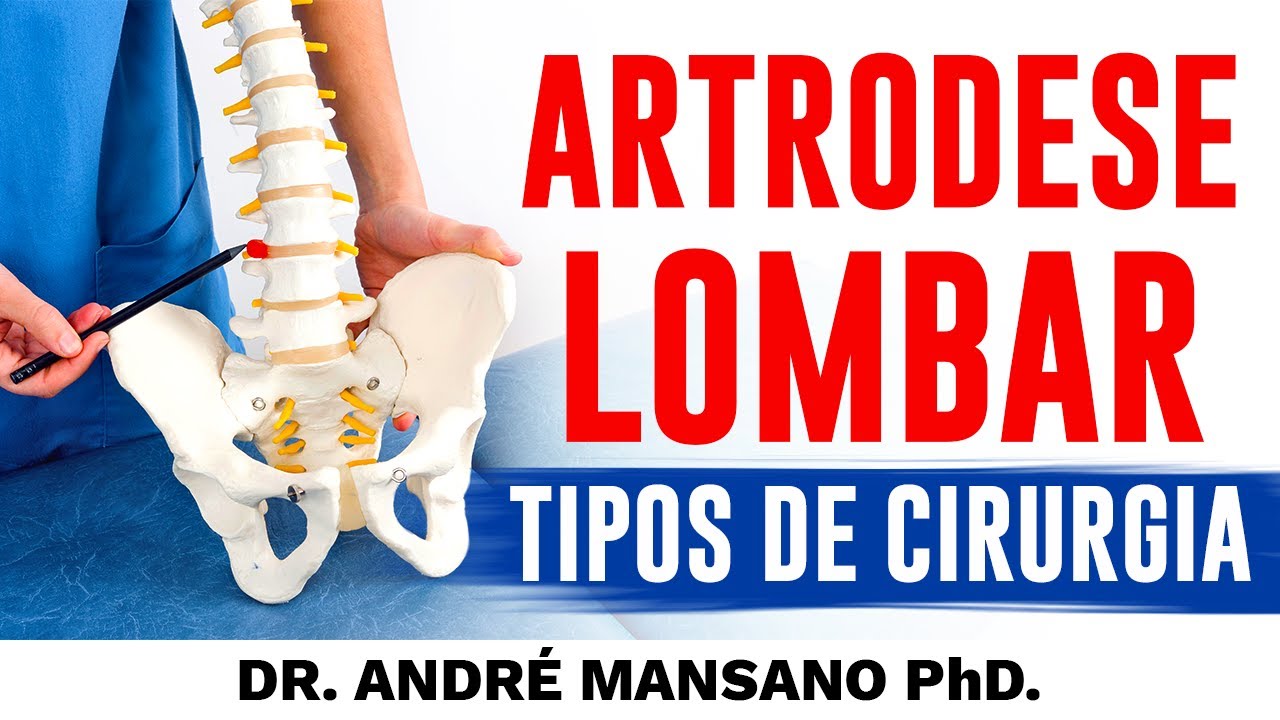 Cirurgia da Coluna Lombar: Tipos e Tratamento da Dor com Dr. André Mansano
