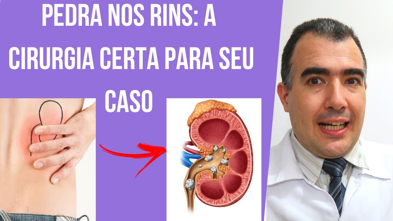 Cirurgia de pedra nos rins: encontre a melhor opção de tratamento para você