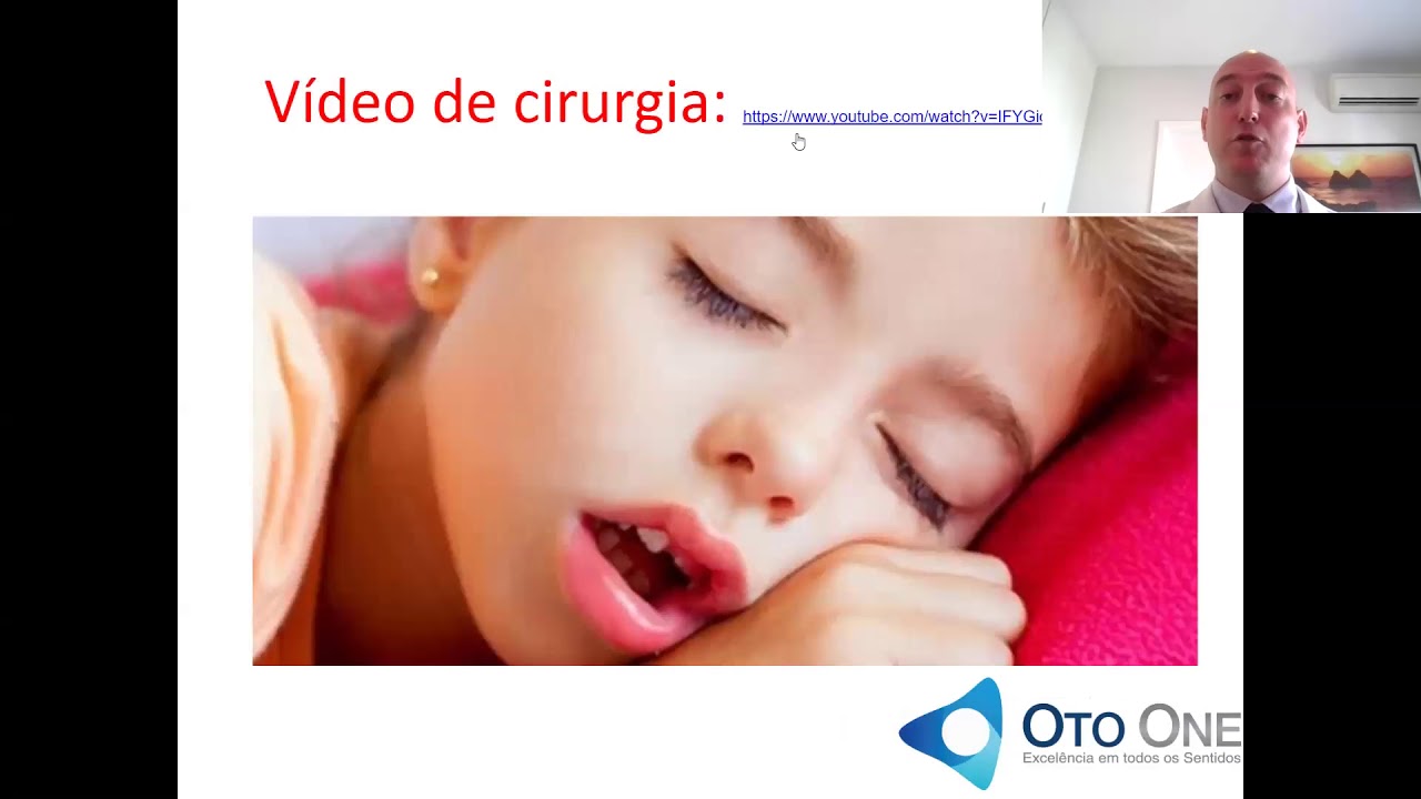 Cirurgia de remoção de amígdalas e adenóides com o Dr. Bruno Rossini ...