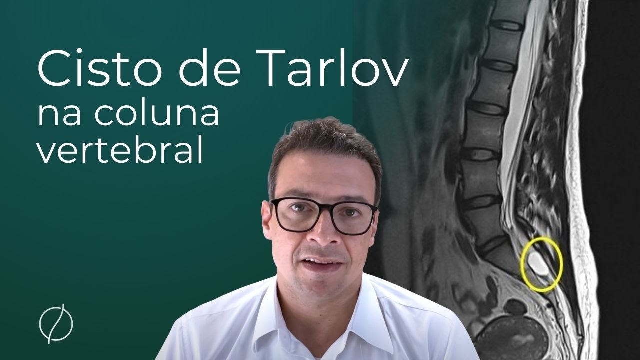 Cisto de Tarlov na coluna vertebral: entendendo o cisto perirradicular ...