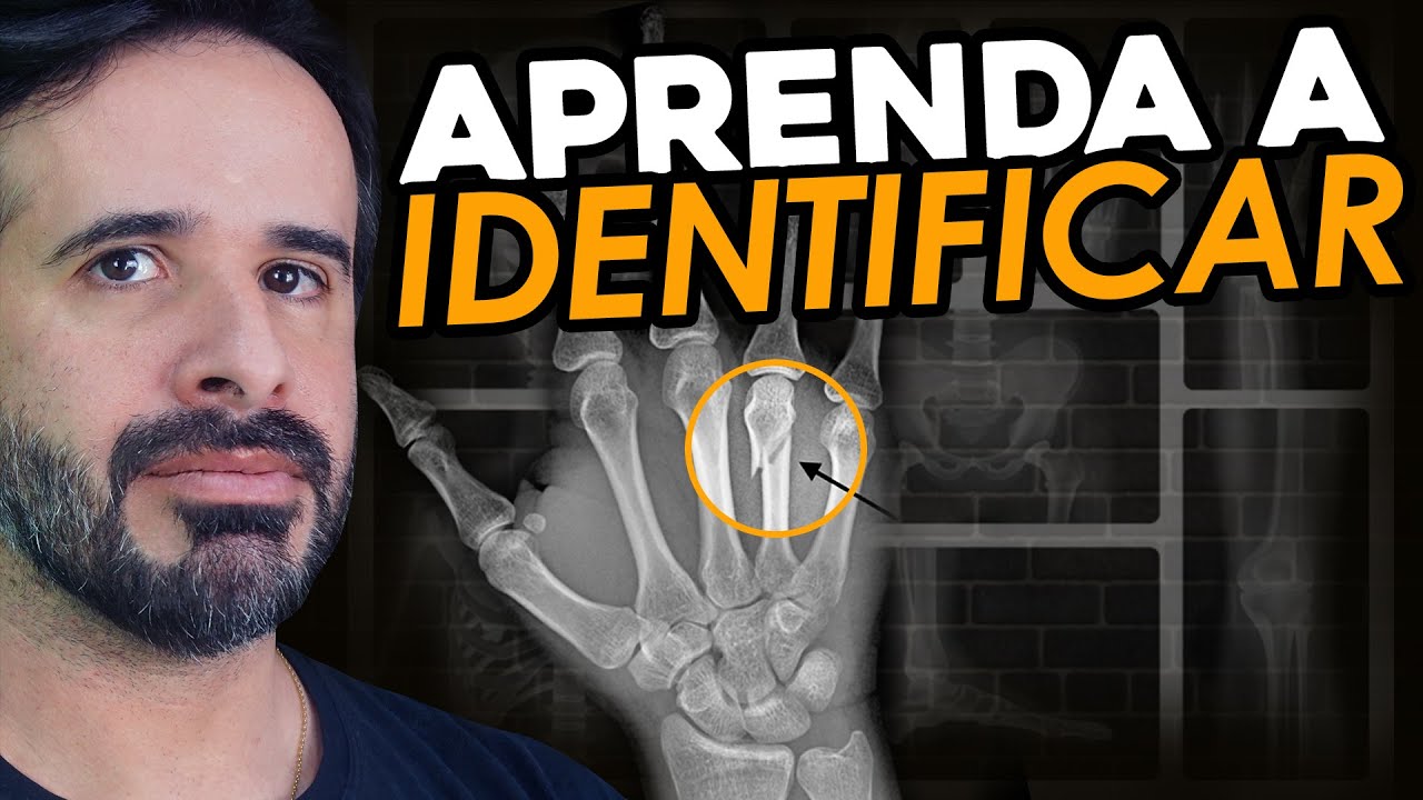 Como identificar fraturas na mão em um raio-x: aprenda aqui