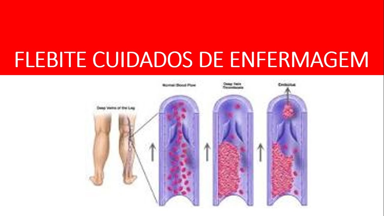 Cuidados de Enfermagem e Tratamento para Flebite: Tudo que você precisa ...