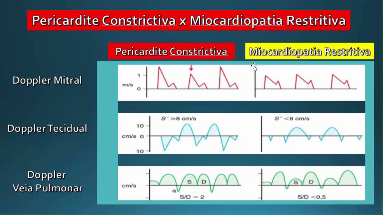 Diferenças entre pericardite constritiva e cardiomiopatia restritiva